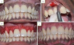 Unveiling the Secrets of Gingival Depigmentation: Techniques and ...